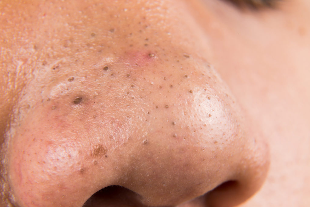 Why Do Teenagers Get Acne?